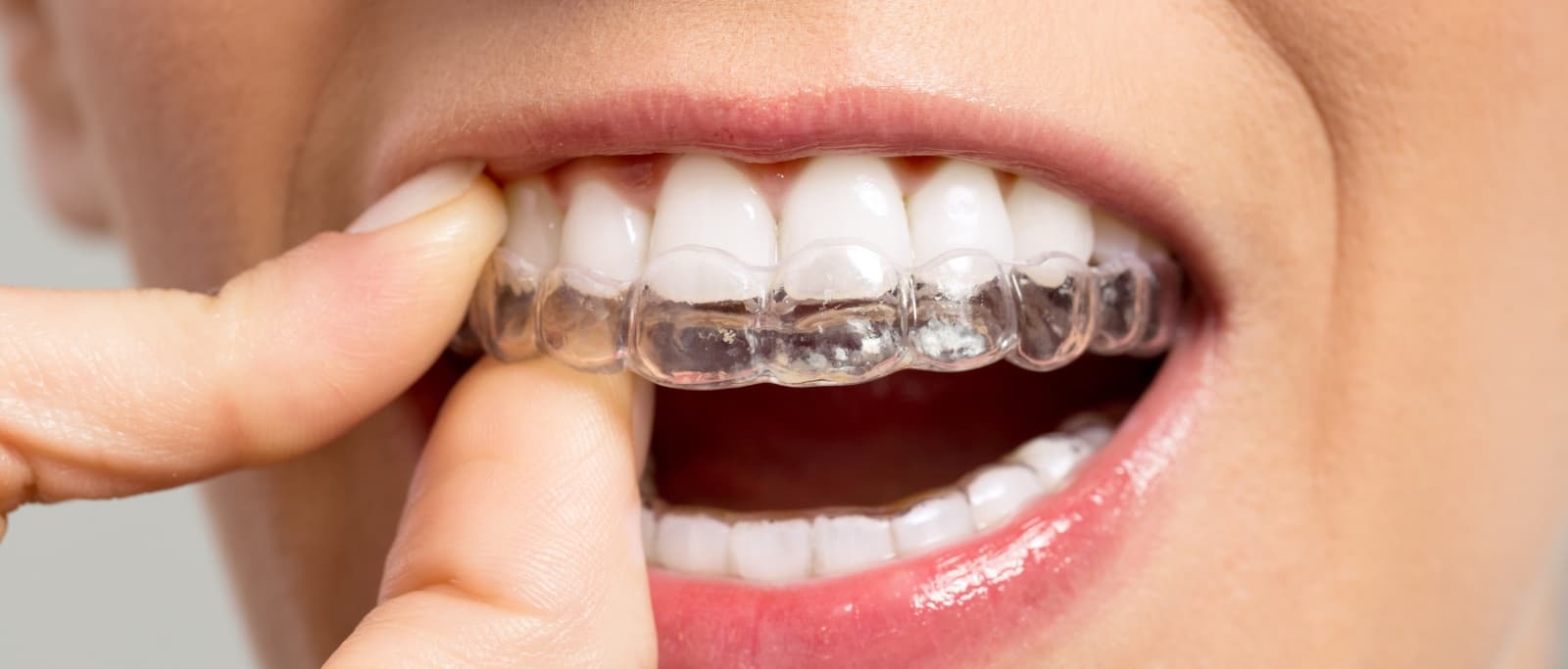 Brackets invisibles: Qué son y cómo funcionan - Clínica Dental Plaza